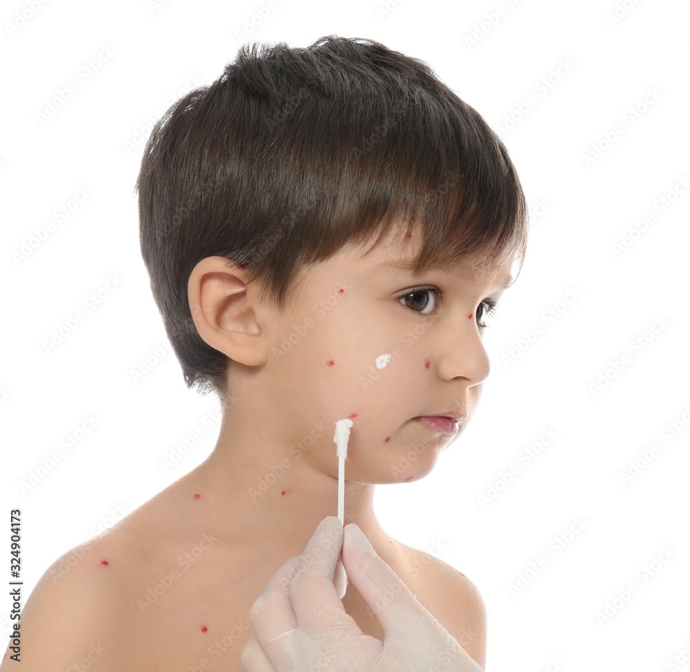 Doctor applying cream onto skin of little boy with chickenpox against ...