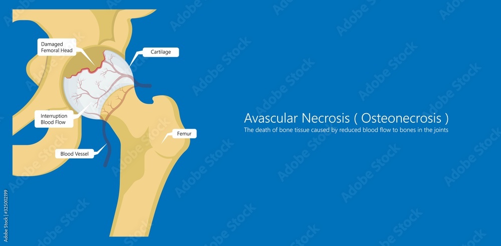 Avascular necrosis bone tissue disease Stock Vector | Adobe Stock
