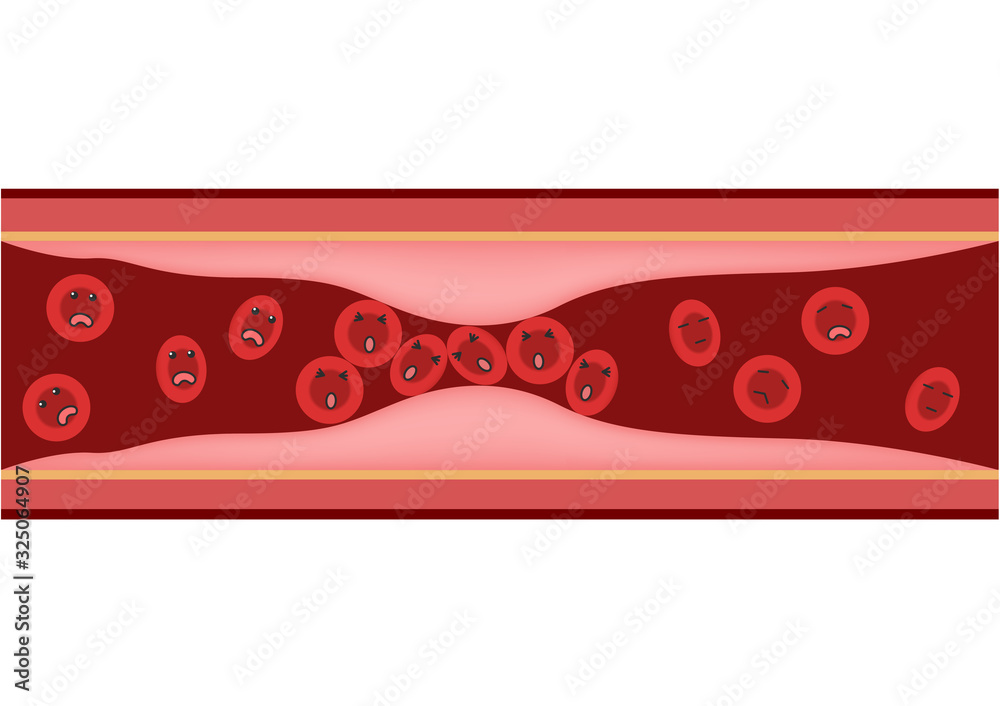 hypertension , high blood pressure vector / human anatomy / cartoon ...