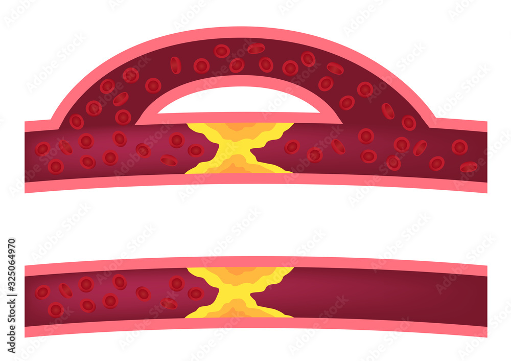 vascular; blood; bypass; vessel; surgery; artery; blockage; health; ill; sick; heart; angio ...