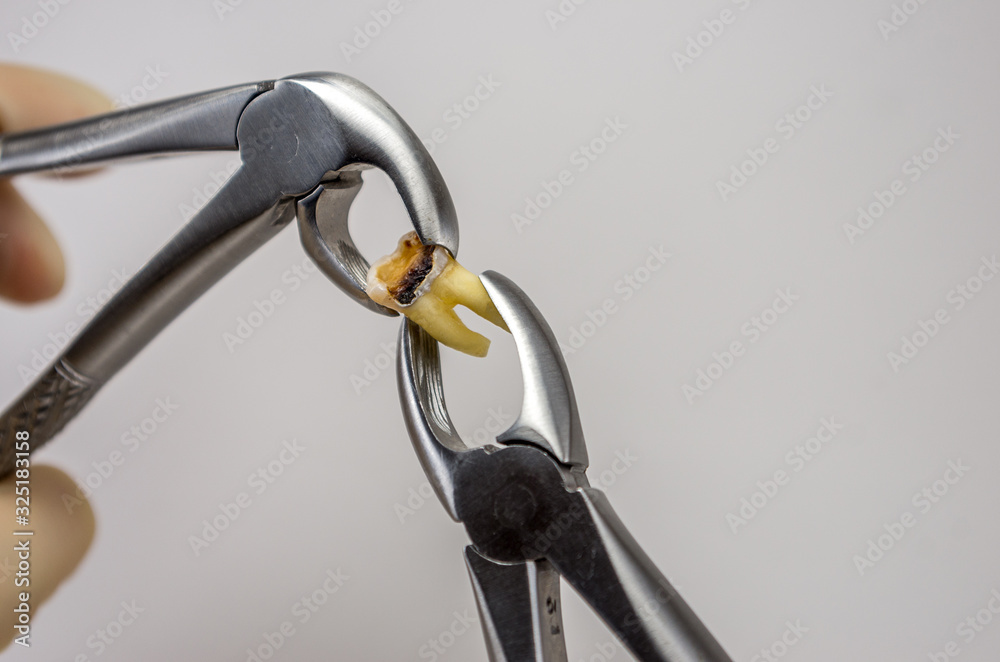 caries-affected destroyed with a large cavity removed human tooth in ...