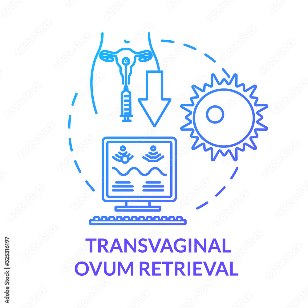 Vector de Stock Transvaginal ovum retrieval blue concept icon. In vitro fertilisation. Vaginal ...