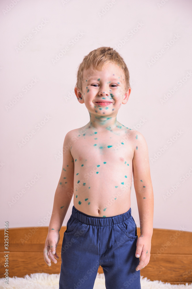 Young toddler,boy with chickenpox. Sick child with chickenpox ...