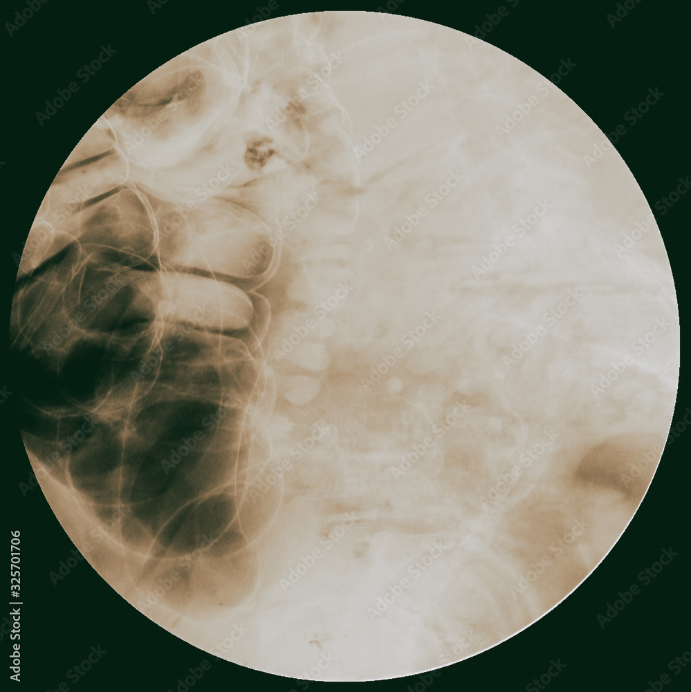 Barium enema image or colorectal x-ray view showing anatomical of large ...