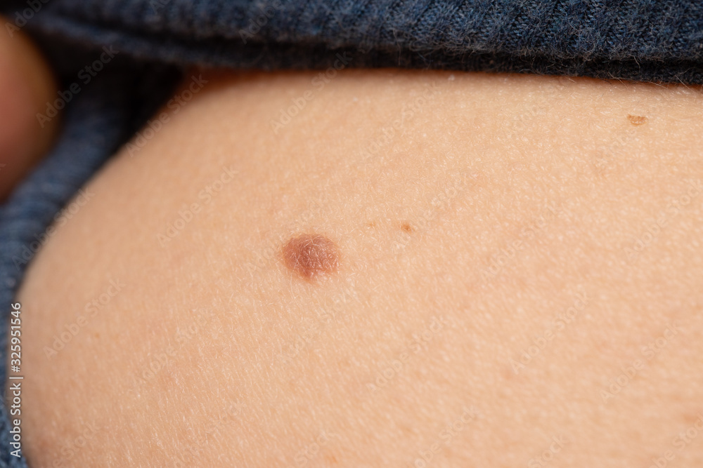 Dark and raised neo on skin. Benign formation. Skin monitoring concept ...