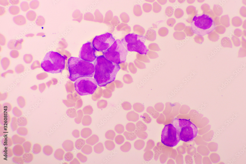 Acute promyelocytic leukemia cells or APL, analyze by microscope ...