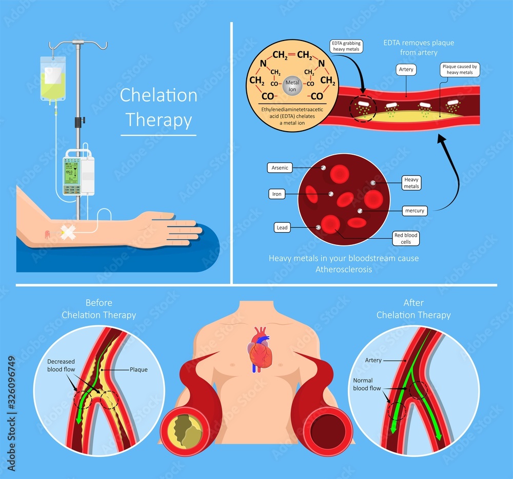 Chelation Therapy lead mercury iron arsenic ethylenediaminetetraacetic ...