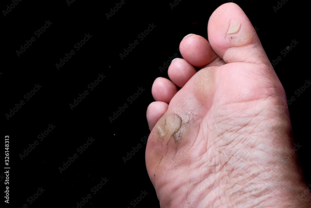feet Infection of the outer epidermis. Skin diseases, Foot Fungus Stock ...