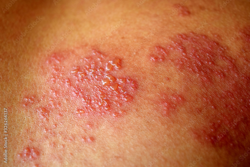 Shingles (Disease),Herpes zoster, severe dermatitis due to a viral ...
