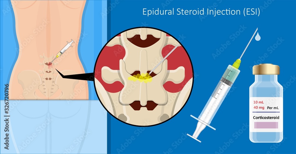 Cortisone shots injection epidural steroid ESI lumbar back spinal ...