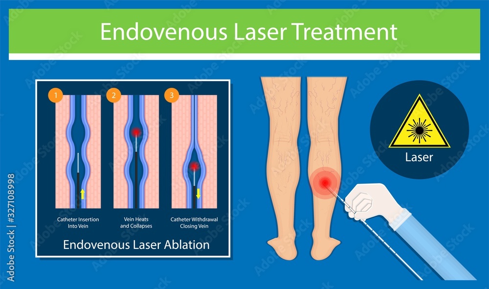 endovenous laser treatment CVD treat ELT legs inject EVLT varicose ...