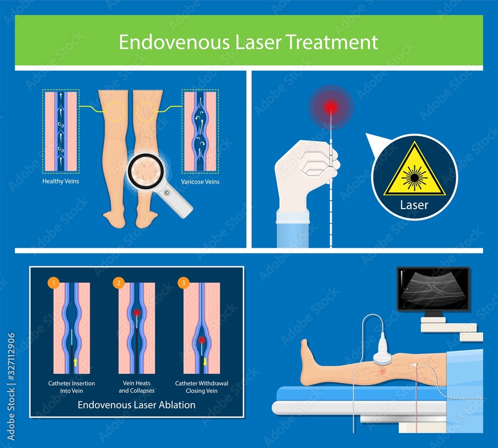 endovenous laser treatment CVD treat ELT legs inject EVLT varicose ...