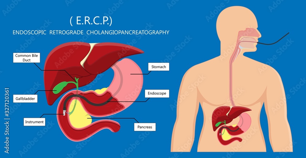 Endoscopic Retrograde Cholangiopancreatography ERCP diagnose treat ...