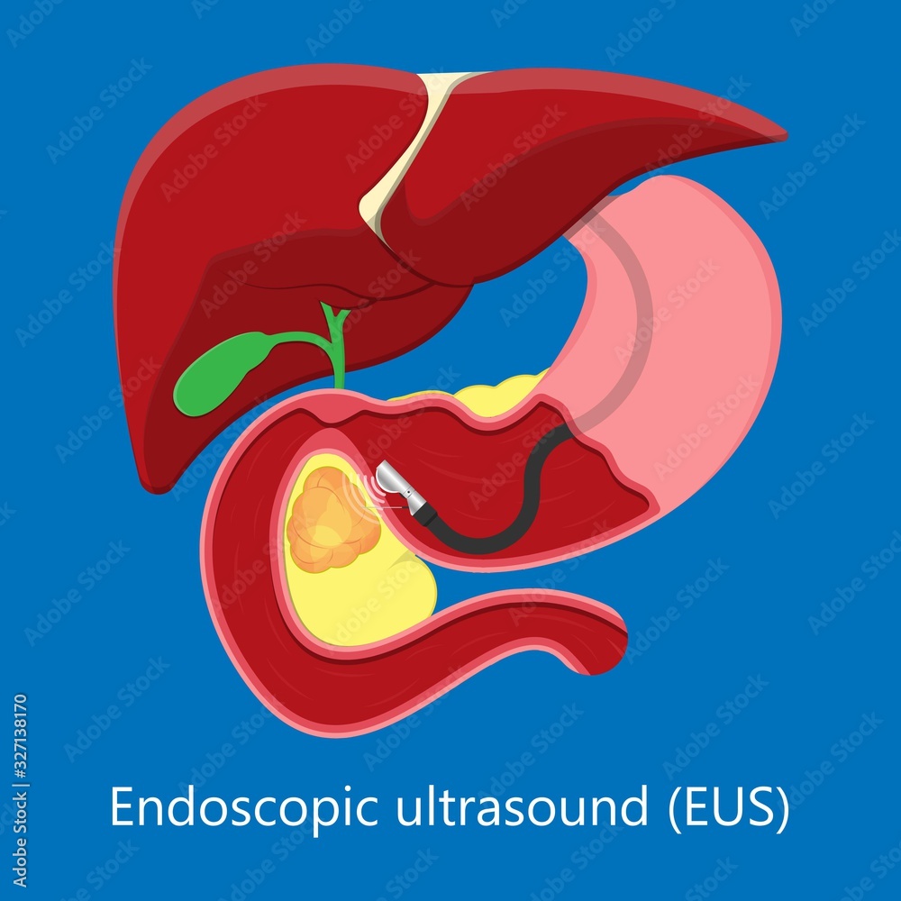 medical endoscopic ultrasound EUS cancer tumor diagnose FNA abdominal ...