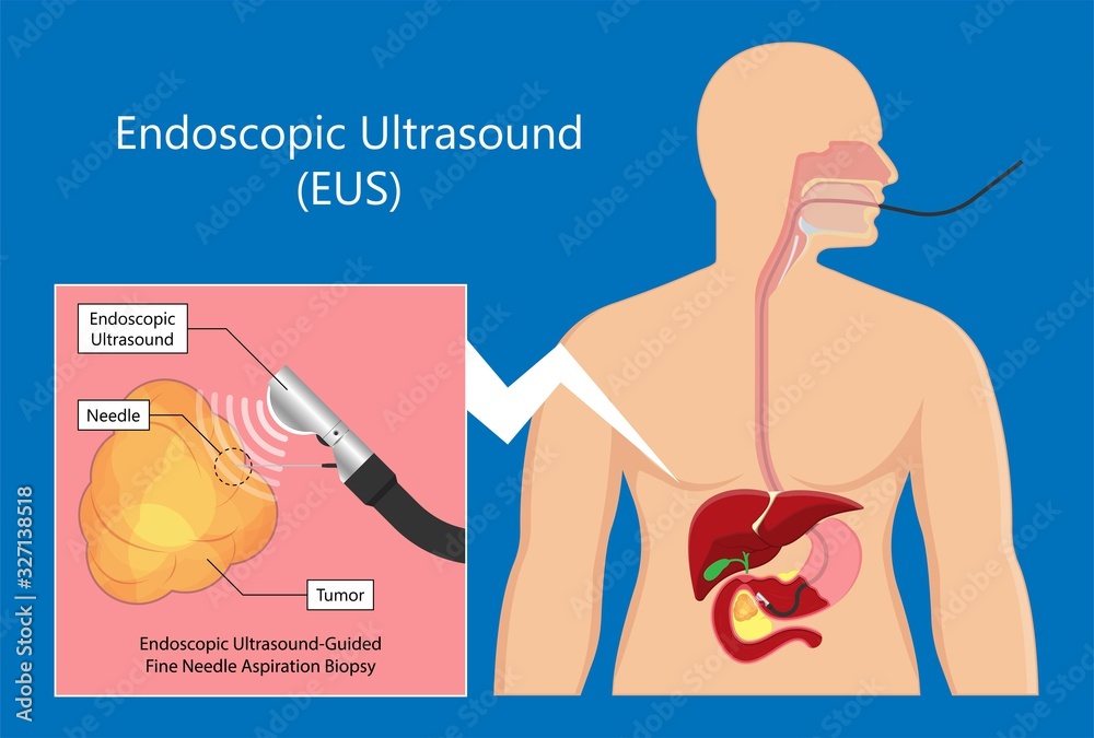 medical endoscopic ultrasound EUS cancer tumor diagnose FNA abdominal ...