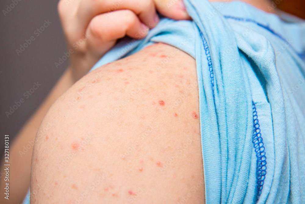 varicella with red spots on the shoulder Stock Photo | Adobe Stock