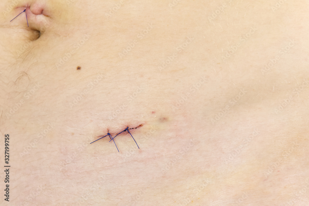 Body scars after appendicitis removal. Small and neat scars after ...