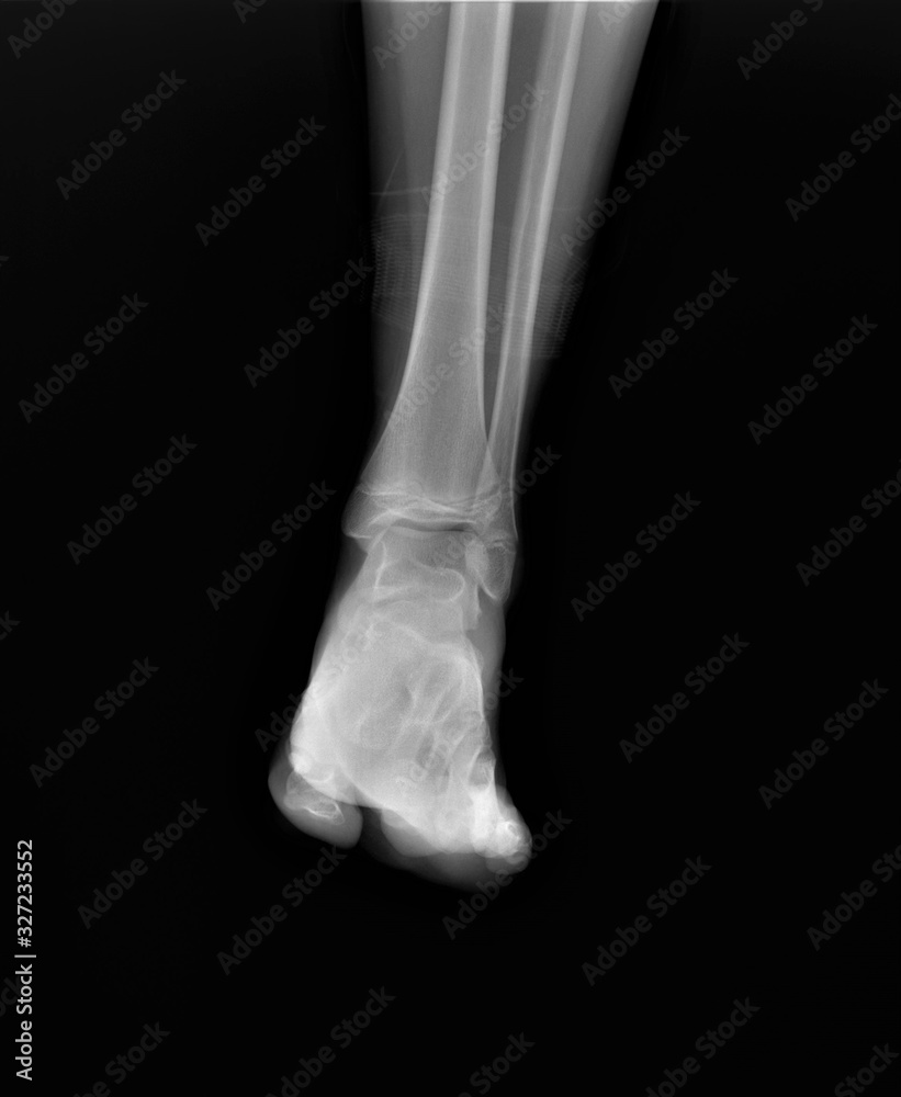x- ray of the ankle joint in the frontal projection, arthritis ...