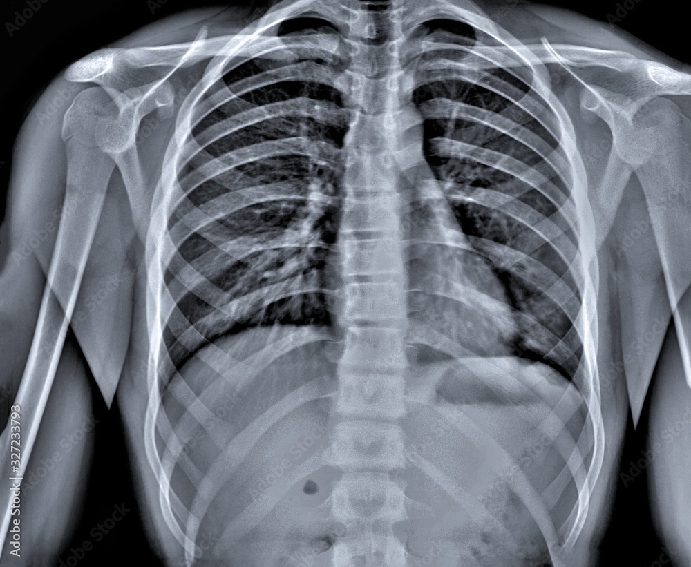 chest x-ray, diagnosis of coronavirus pneumonia Stock Photo | Adobe Stock