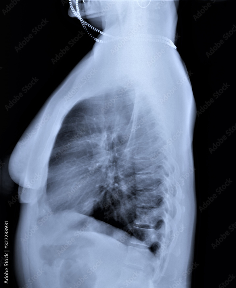 chest x-ray in lateral projection, diagnosis of pneumonia Stock Photo ...