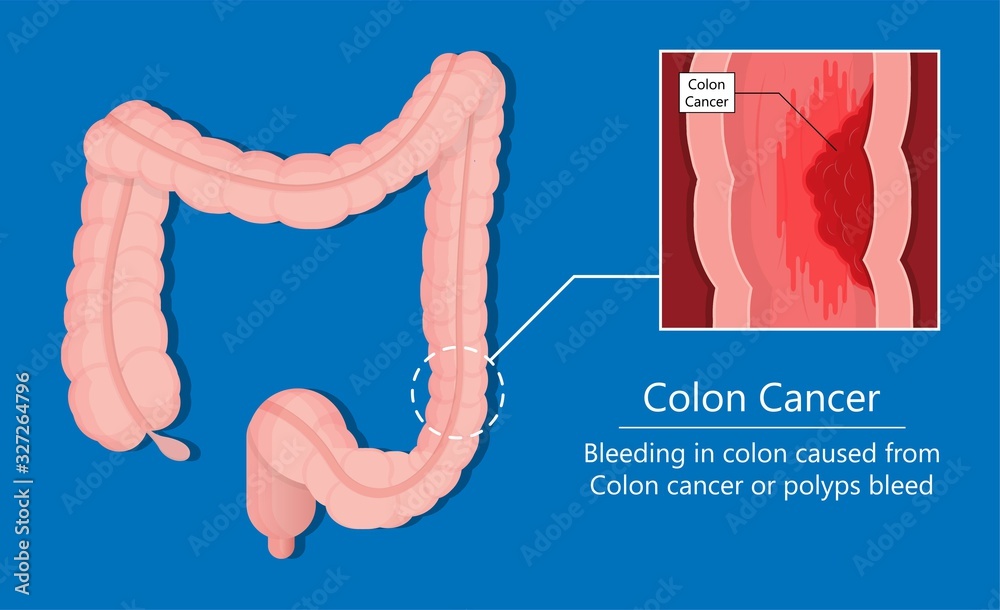 Fecal occult blood test FOBT lab stool sample bleeding screen risk ...