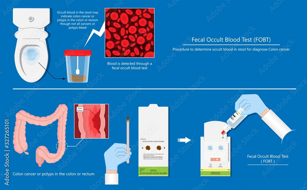 Image vectorielle Stock Fecal occult blood test FOBT lab stool sample ...