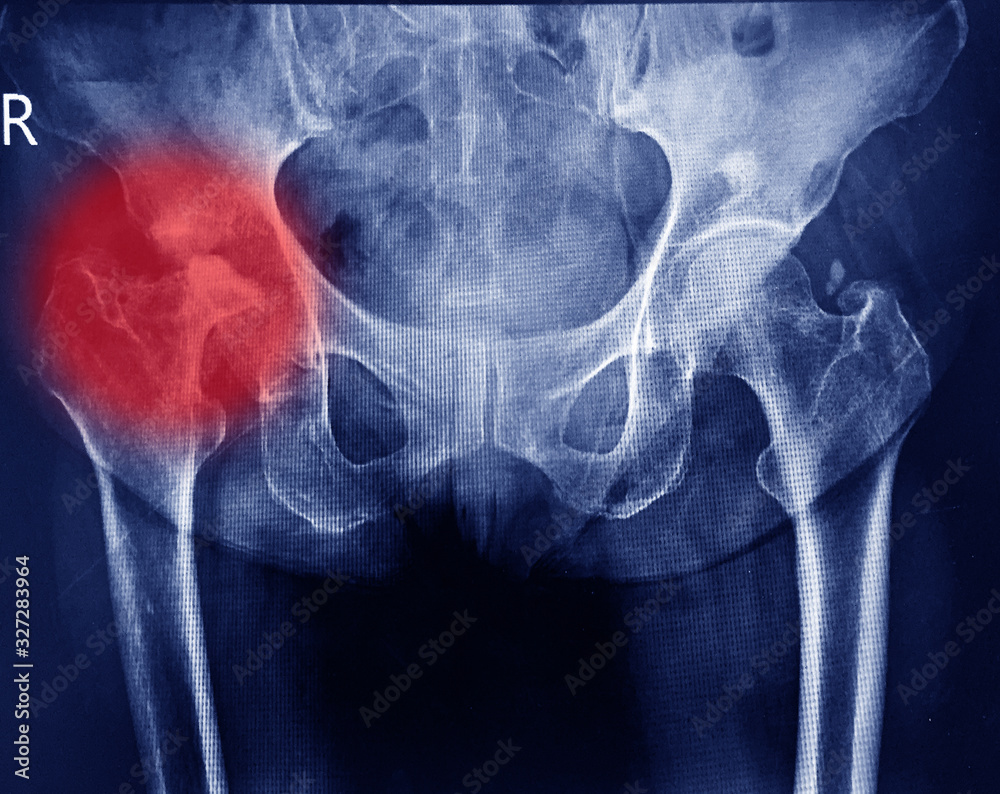 Both hips joint x-ray showing destruction head right femur and erosion ...