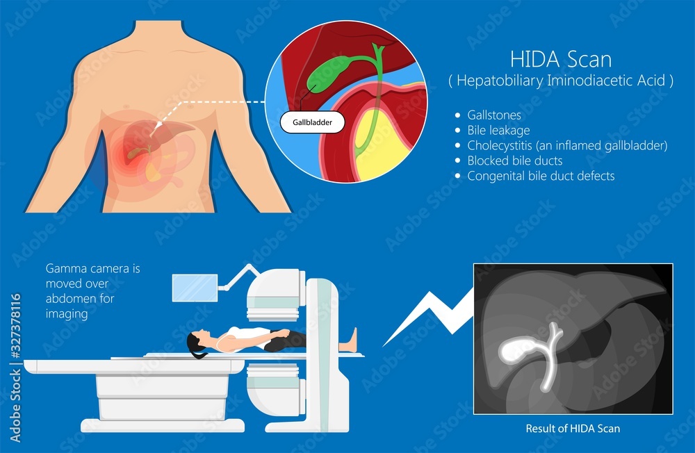 Image vectorielle Stock HIDA scan diagnosis treat liver scintigraphy ...