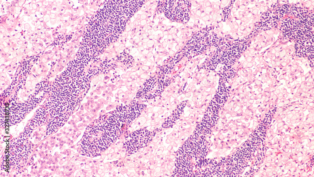 Microscopic image (photomicrograph) of a poorly differentiated gastric ...