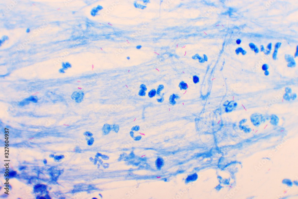 Mycobacterium tuberculosis positive (small red rod) in sputum smear ...