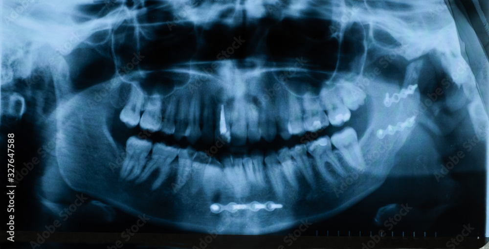 Foto de Stock Panoramic X-ray of the jaw after fracture and ...