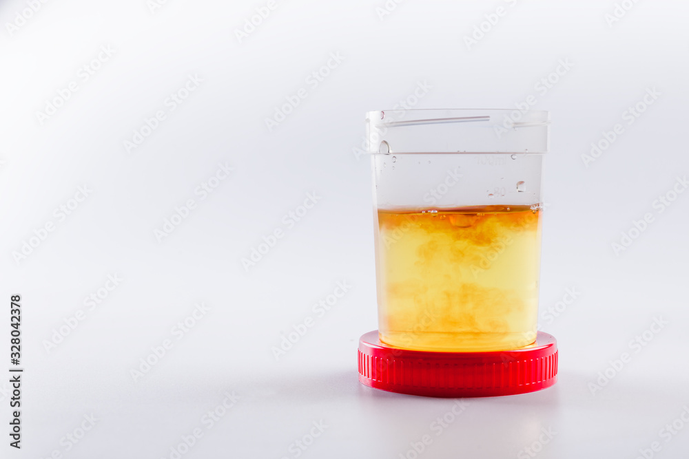 Foto de Stock Cloudy or bloody urine sample in sterile plastic ...