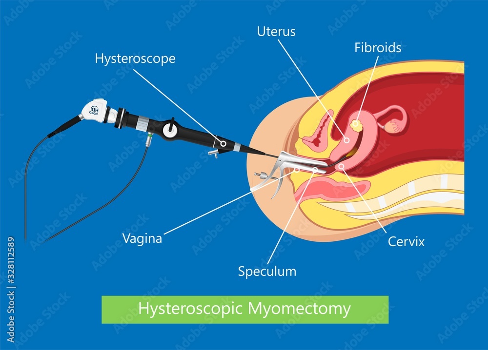 laparoscopic hysterectomy medical surgical treat cervix ovary subtotal ...