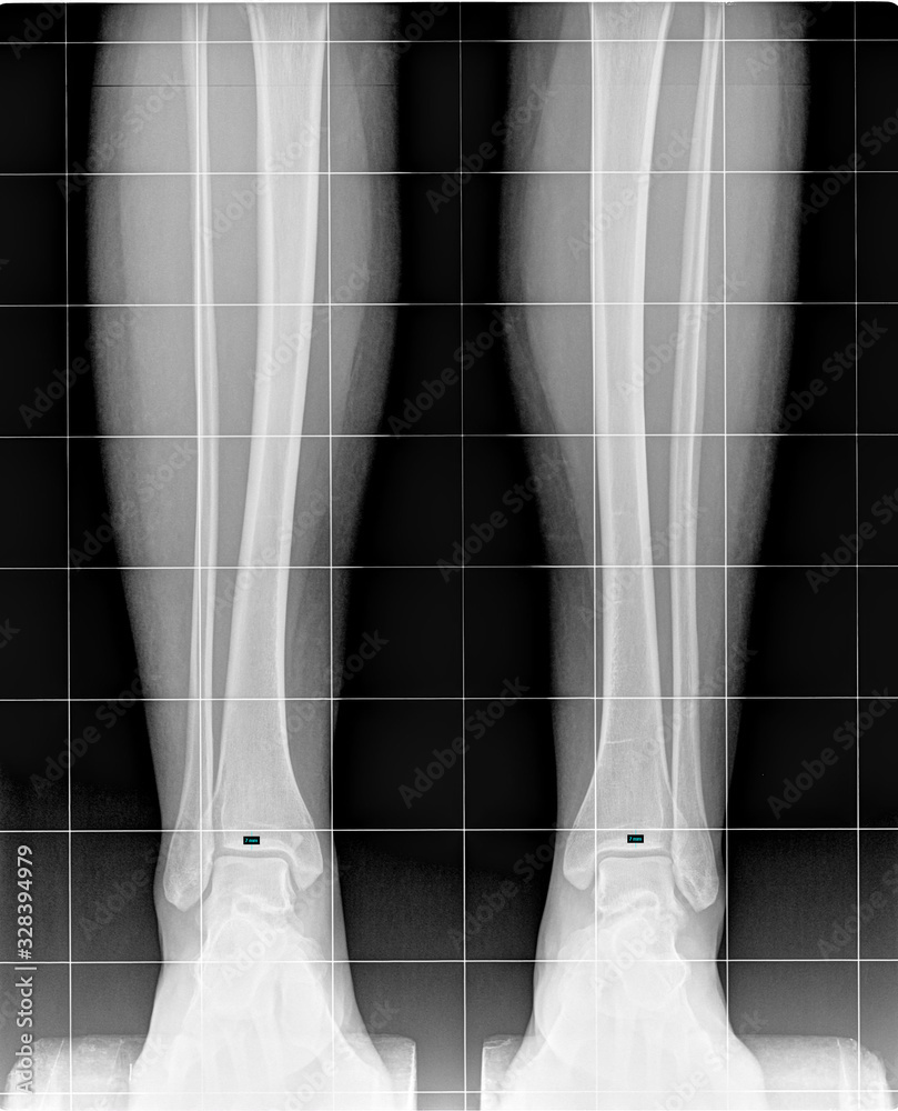 Two legs, ankles and feet radiograph. Grid into the X-ray white and ...