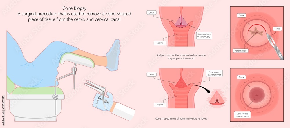 Cold knife cone biopsy Loop Electrosurgical Excision Procedure LEEP ...