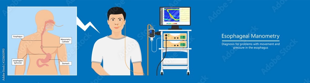 Esophageal manometry test esophageal diagnose food high resolution ...