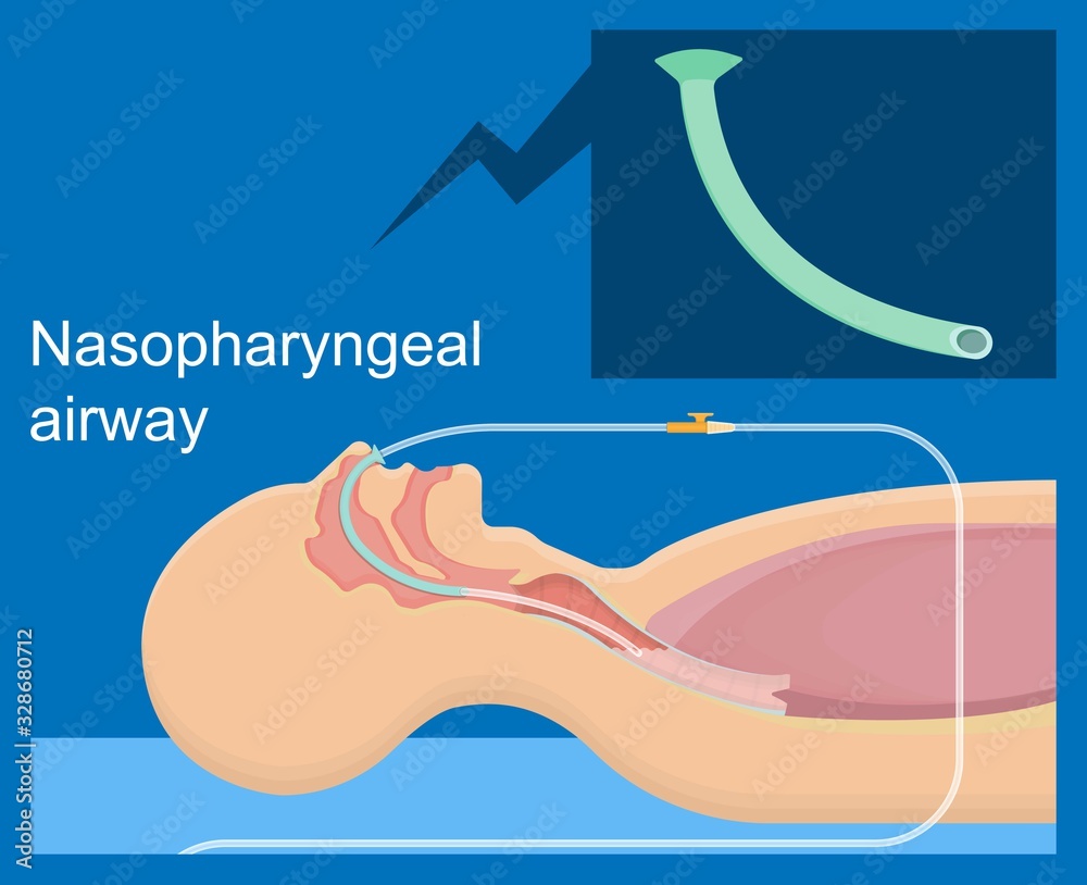 Suction patient adult nares unit lung clear fluid tube nose nasal pump ...