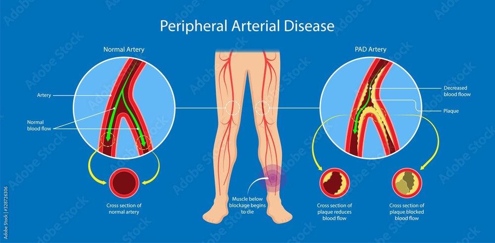 Peripheral artery disease ankle brachial index ABI test limb ischemia ...