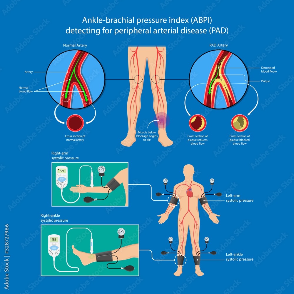 Peripheral artery disease ankle brachial index ABI test limb ischemia ...