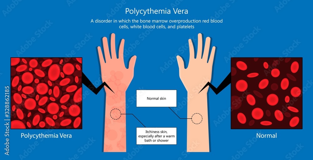 Polycythemia vera PV blood clots cancer bone marrow diagnostic complete ...