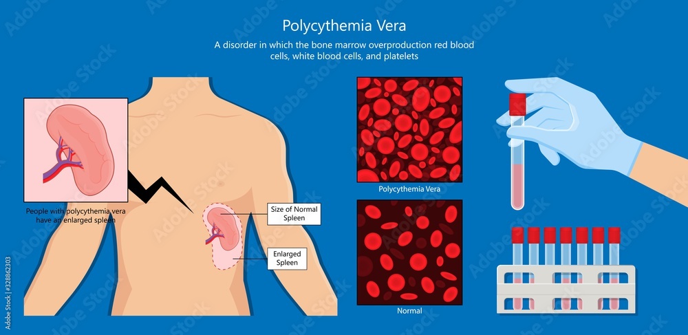 Polycythemia vera PV blood clots cancer bone marrow diagnostic complete ...