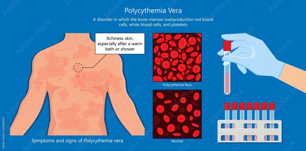 Polycythemia vera PV blood clots cancer bone marrow diagnostic complete ...
