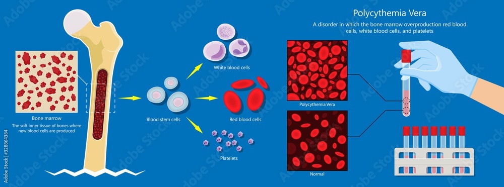 Polycythemia vera PV blood clots cancer bone marrow diagnostic complete ...