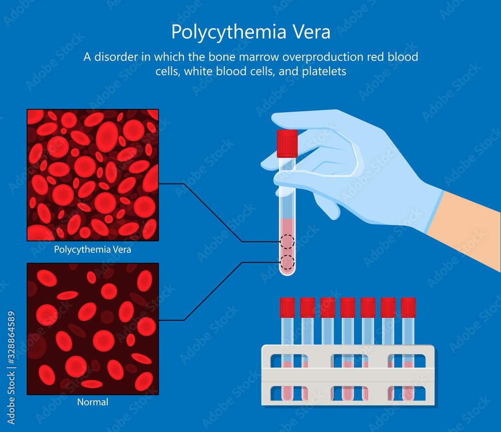 Polycythemia vera PV blood clots cancer bone marrow diagnostic complete ...