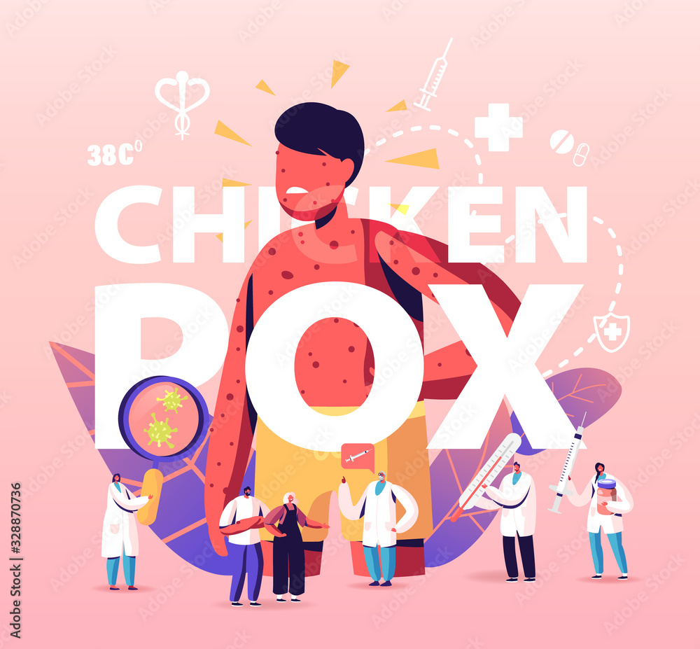 Vektor Chicken Pox Varicella Concept. Tiny Doctors Characters near Huge ...