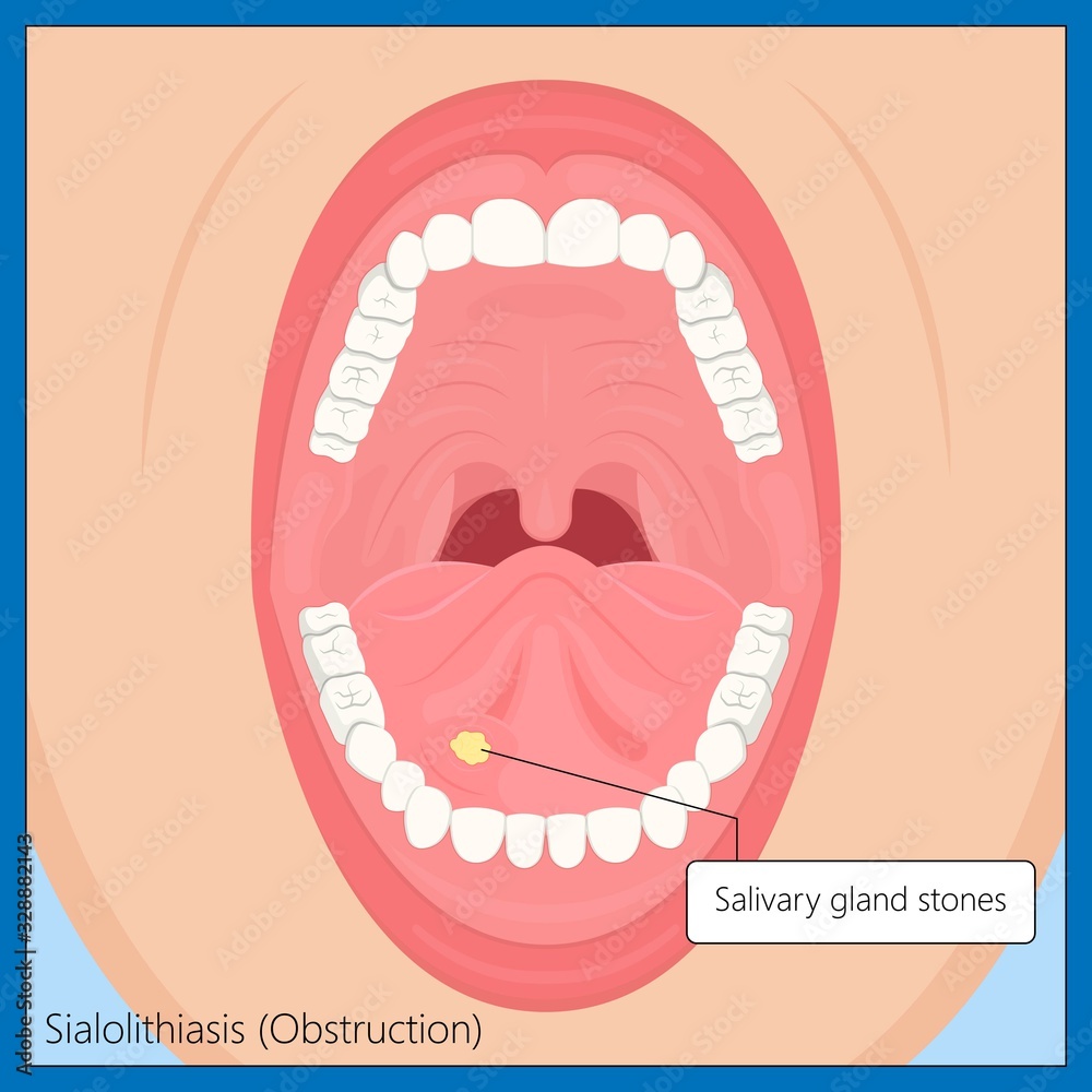 Parotid gland Sialadenitis bacterial infection Sialolithiasis blockage ...