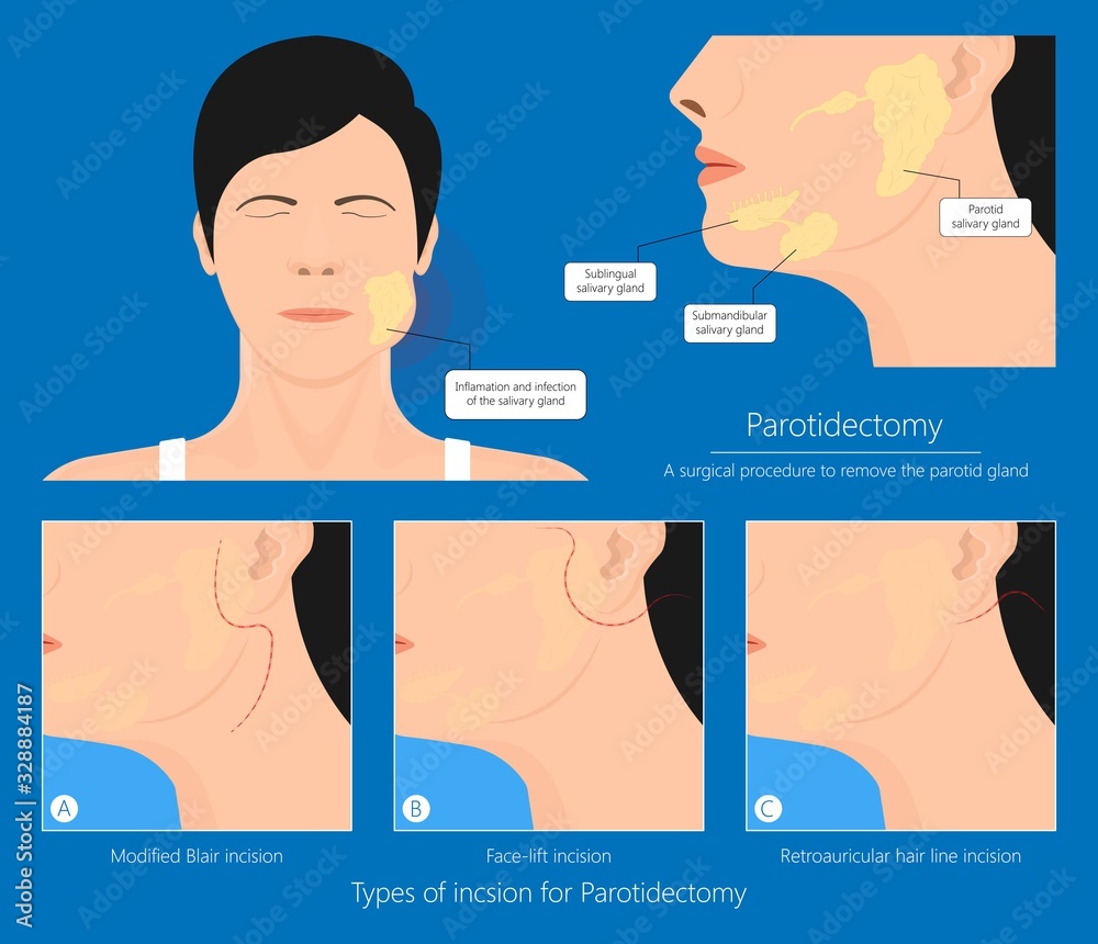 Parotid gland Sialadenitis bacterial infection Sialolithiasis blockage ...