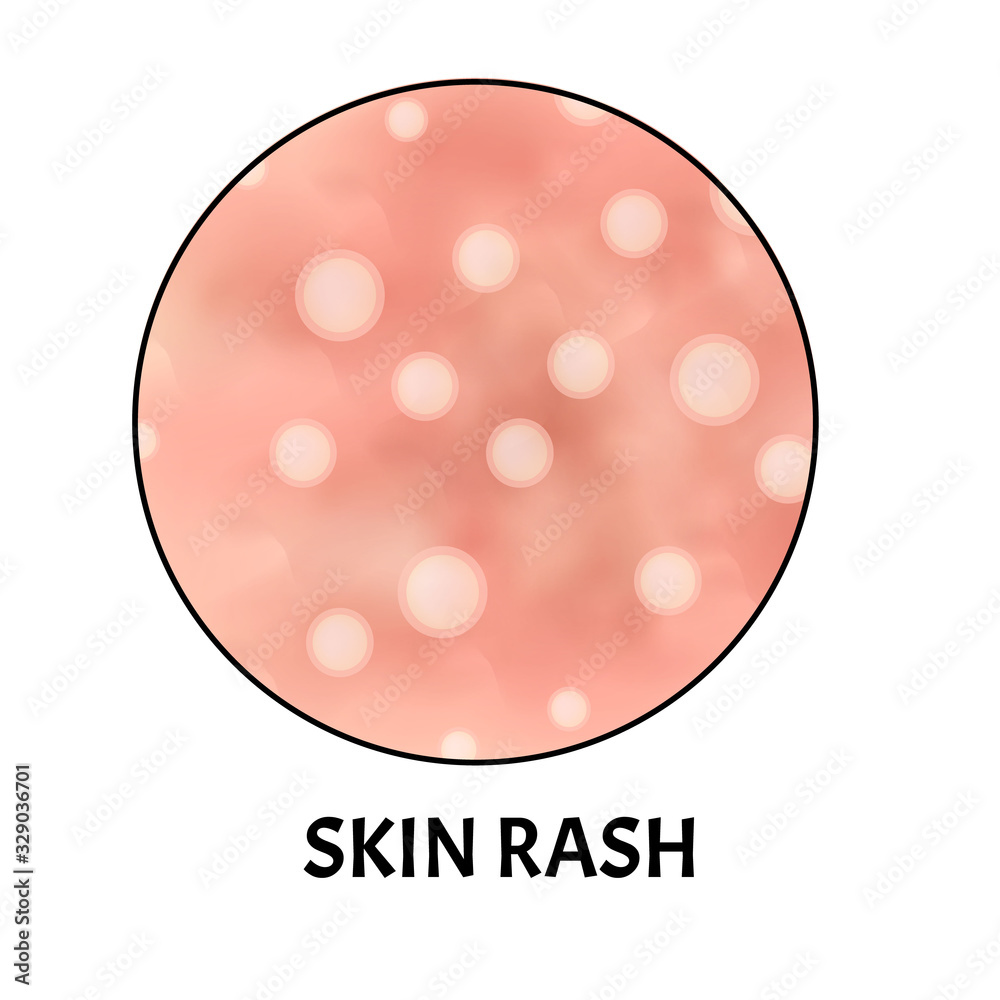 Skin rash. Symptom of dermatitis, allergies, psoriasis, eczema. Icons ...