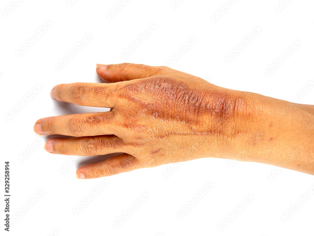 hand of a middle-aged woman burned on white background isolate ...