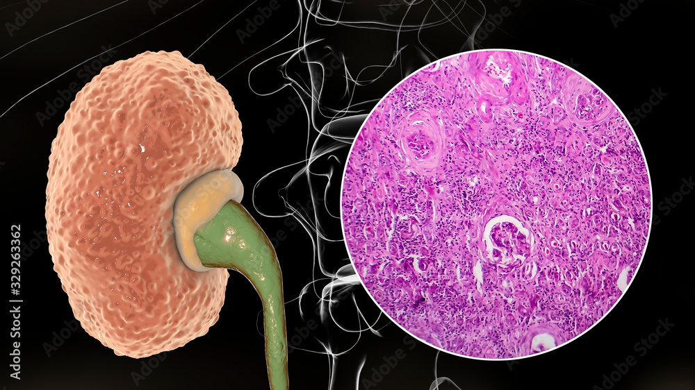 Chronic glomerulonephritis, 3D illustration showing pale contracted ...